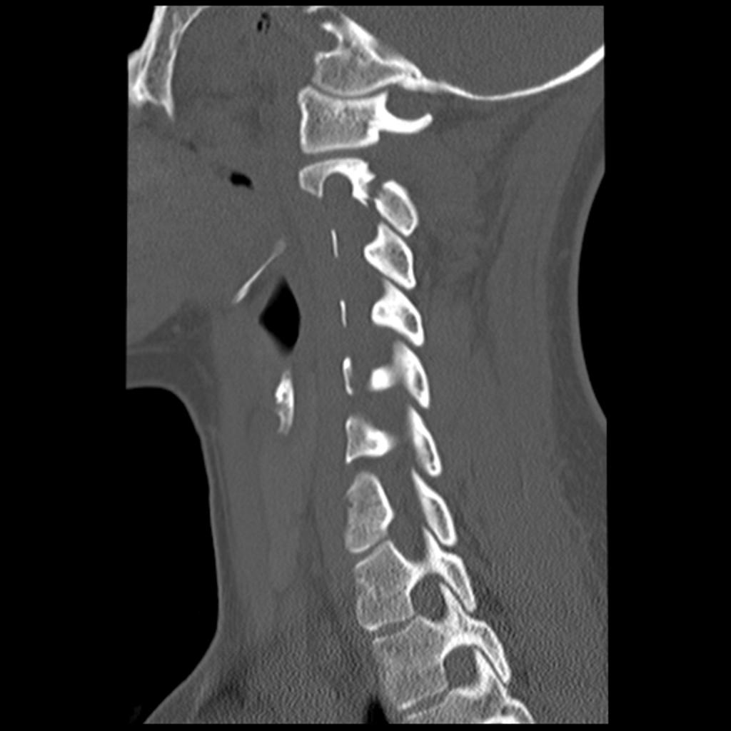 C-Spine Injuries + CT Interpretation – Core EM