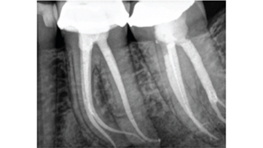 Shaping, Disinfecting and Obturating Root Canals - Decisions in Dentistry