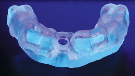 Stereolithography: The Future of Dental Fabrication - Decisions in ...