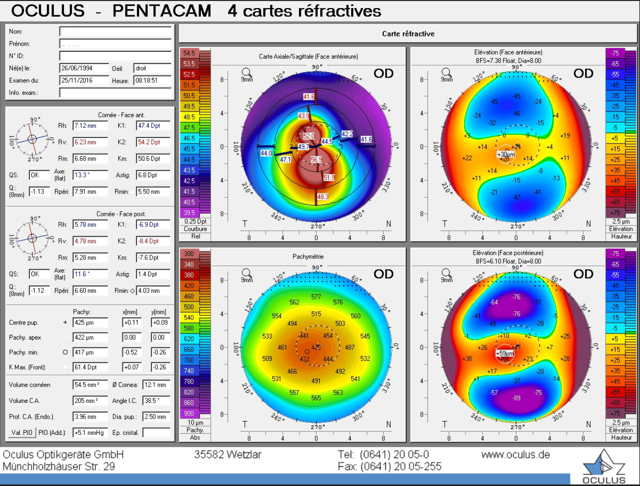 Case #19 | Defeat Keratoconus