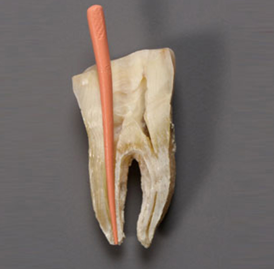 False and True Tug-Back in Endodontic Obturation