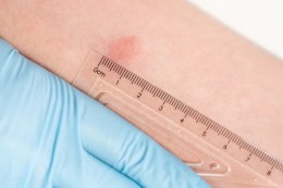 Incredible Can I Swim After Tb Skin Test References
