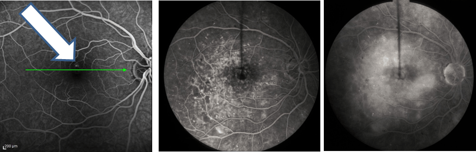 It’s All About ME – What to Know About Macular Edema - Discovery Eye ...