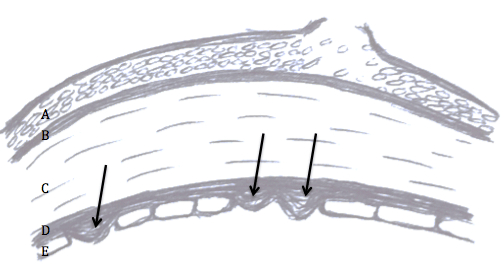 Fuchs’ Dystrophy: Current Insights - Discovery Eye Foundation