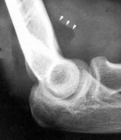Elbow X-Rays