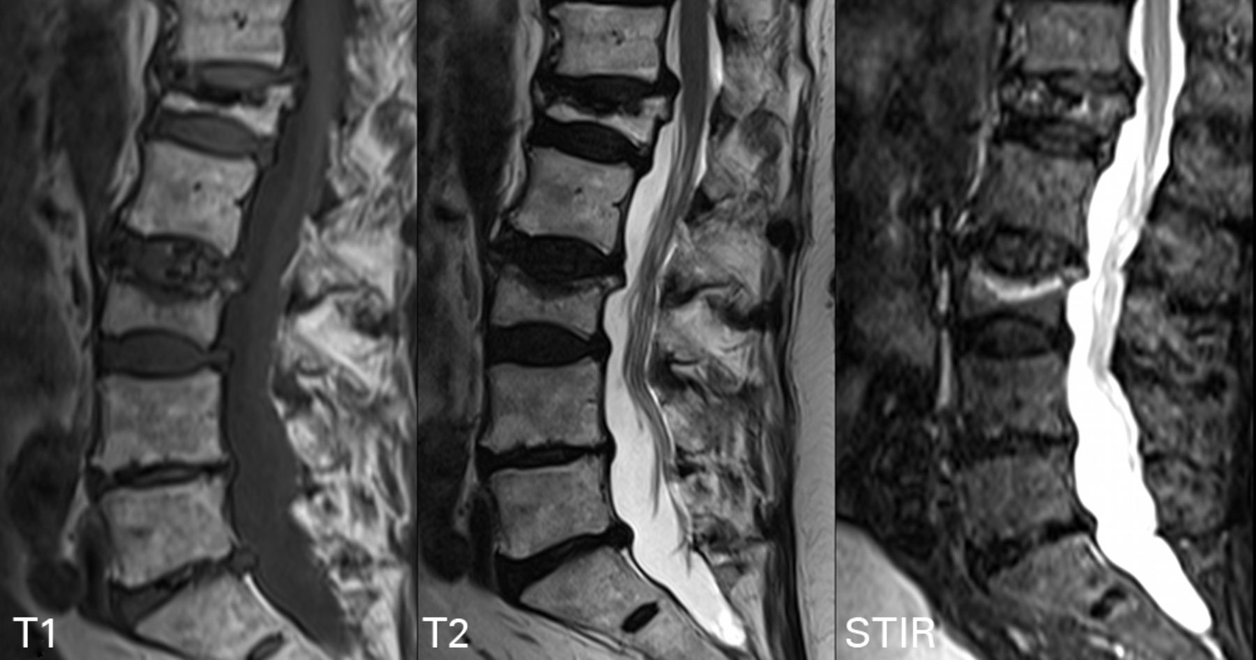 Kyphoplasty – Gardendale Pain & Wellness