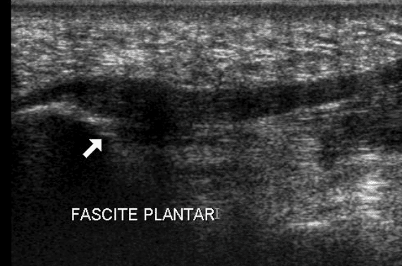 Fascite plantar: causas, tratamentos e como diagnosticar - Educa Cetrus