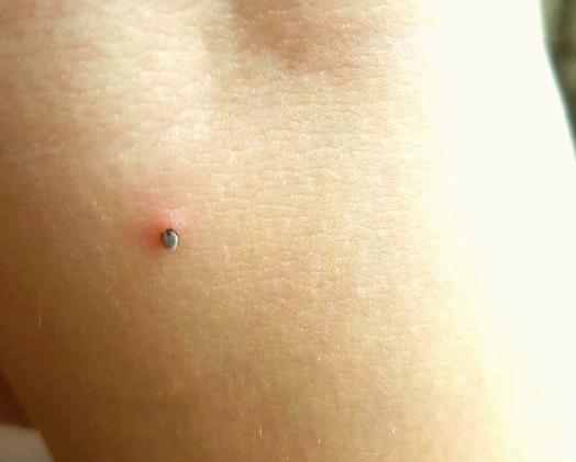 Quand la piqûre de tique devient-elle dangereuse?