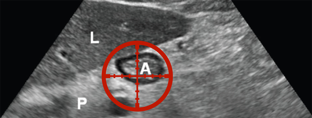 PulmCrit Wee: Ultrasound-guided blakemore tube placement