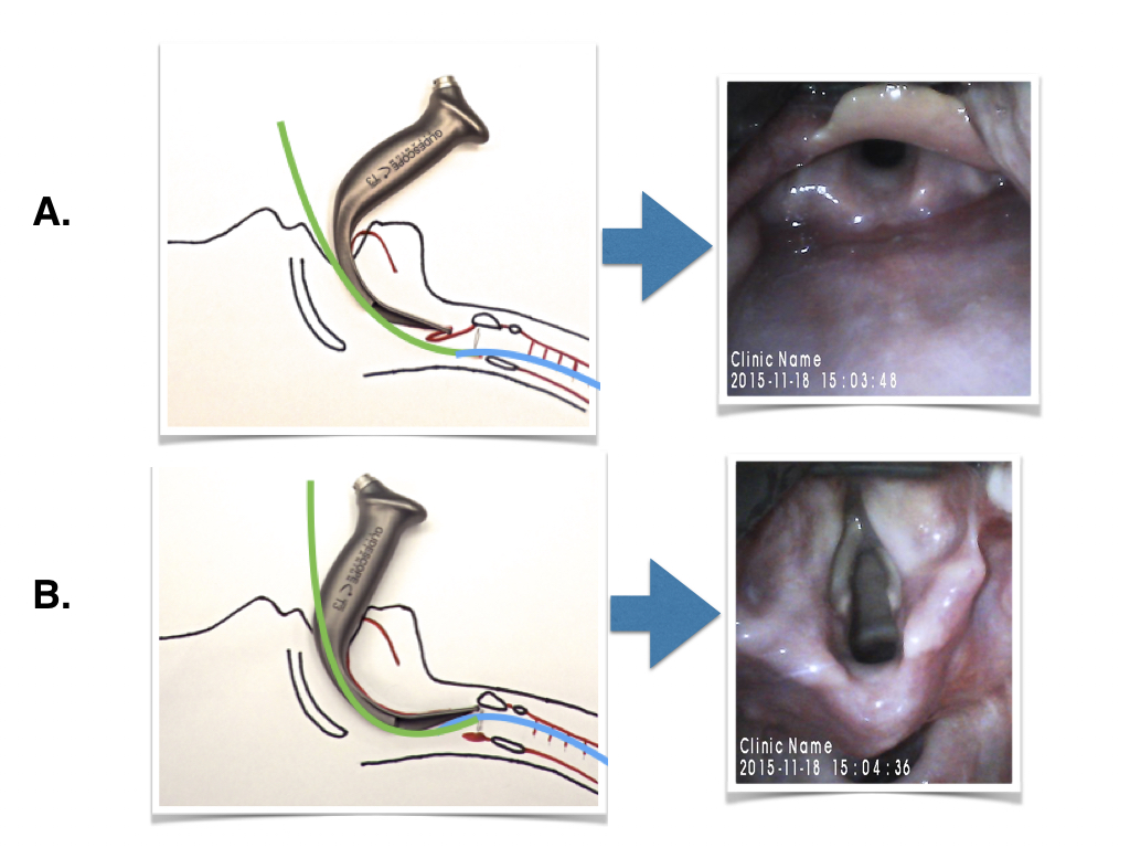 Lights Camera Action: Redirecting Videolaryngoscopy (Guest Post)