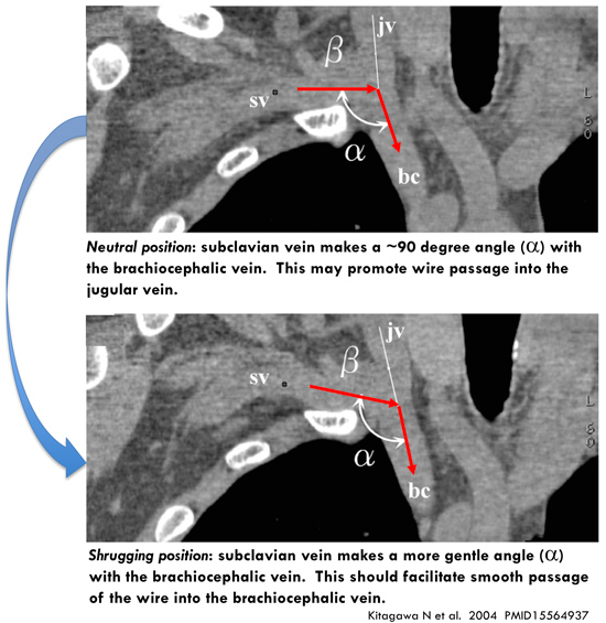PulmCrit- Shrug Technique for US-guided subclavian lines
