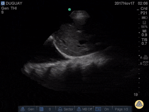 Chest sonography - EMCrit Project