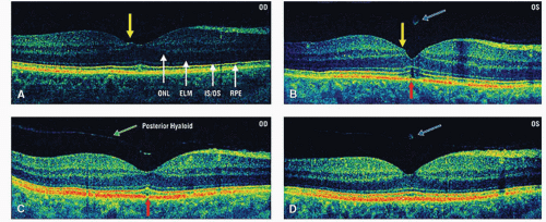 Pathophysiology of the Vitreoretinal Interface | Ento Key