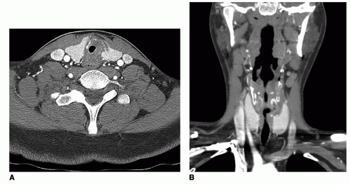 Tracheal Tumors | Ento Key