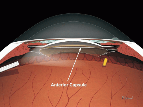 Management of Suprachoroidal Hemorrhage | Ento Key