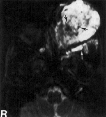 Vascular Hamartomas, Hyperplasia, and Neoplasms | Ento Key