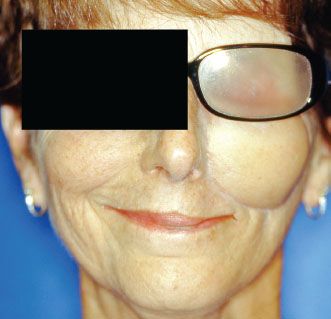 Management of the Cheek Defect: Free Flap Reconstruction | Ento Key