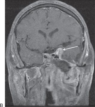 Suprapetrous Approach to Meckel’s Cave and the Middle Cranial Fossa ...