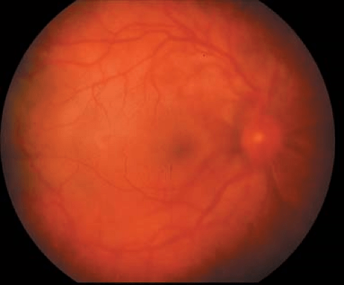 Peripheral Retinal Disease | Ento Key
