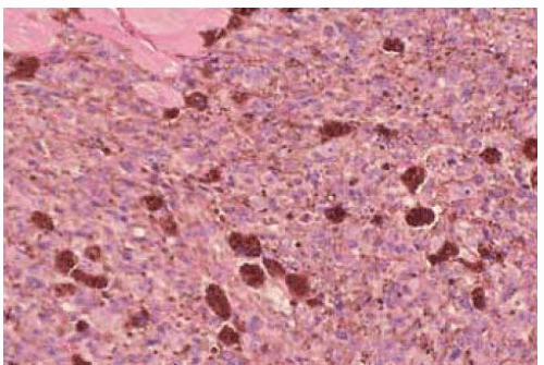 Eyelid Lymphoid, Plasmacytic, and Metastatic Tumors | Ento Key