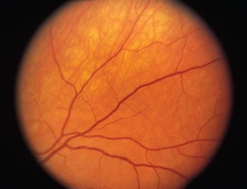 21 Hereditary Retinitis Pigmentosa | Ento Key