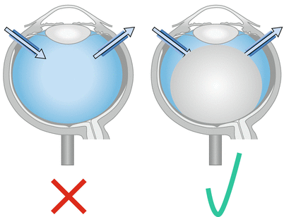 Principles of Internal Tamponade | Ento Key