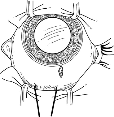 Incision | Ento Key