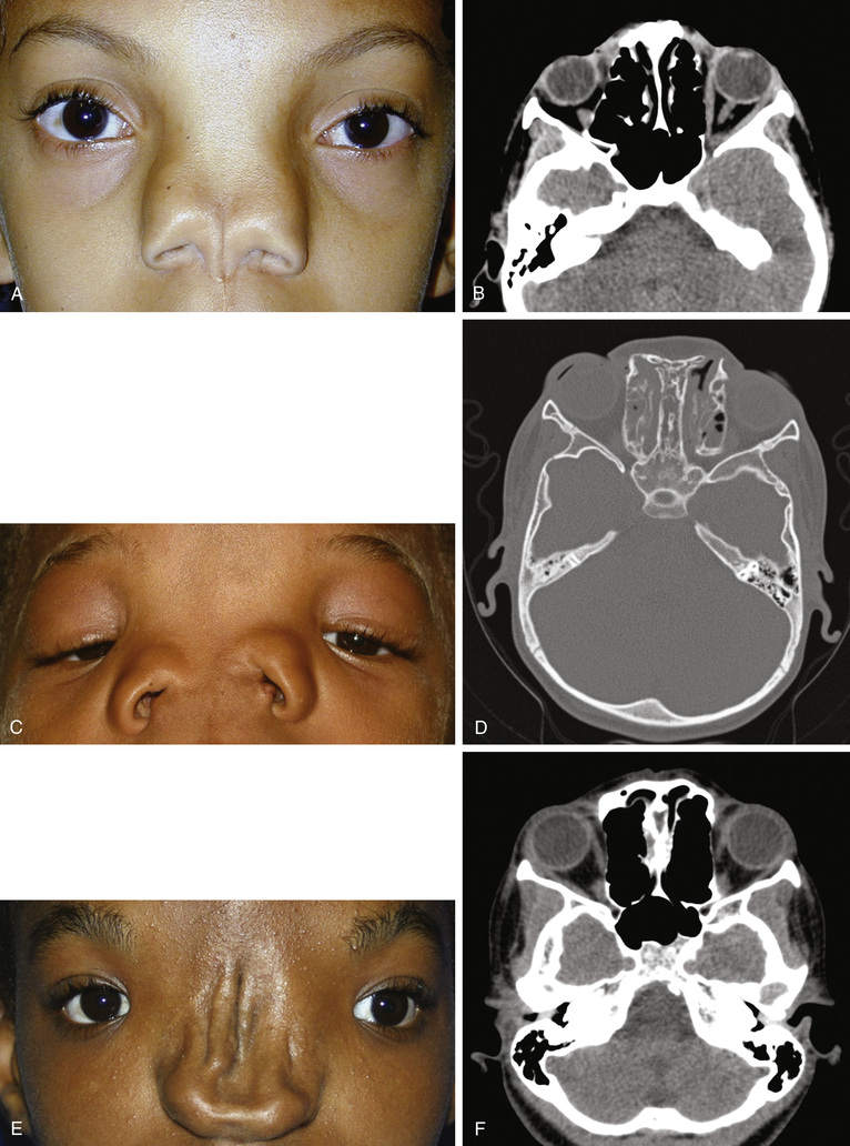 Orbital Developmental Disorders | Ento Key