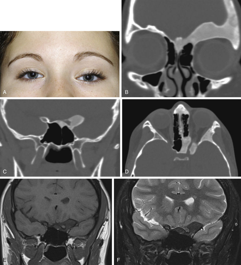 Orbital Bone Tumors | Ento Key