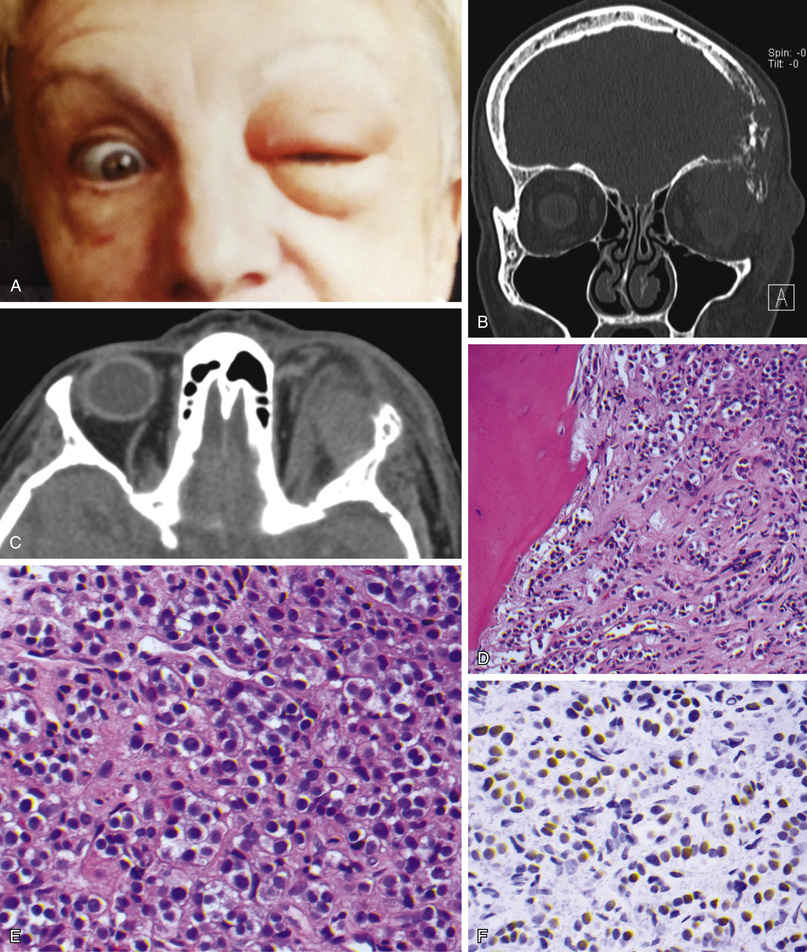 Orbital Bone Tumors | Ento Key