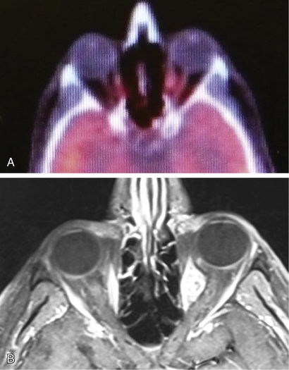 Metastatic and Secondary Orbital Tumors | Ento Key
