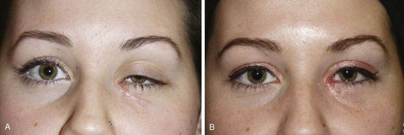Upper Eyelid Ptosis and Retraction | Ento Key