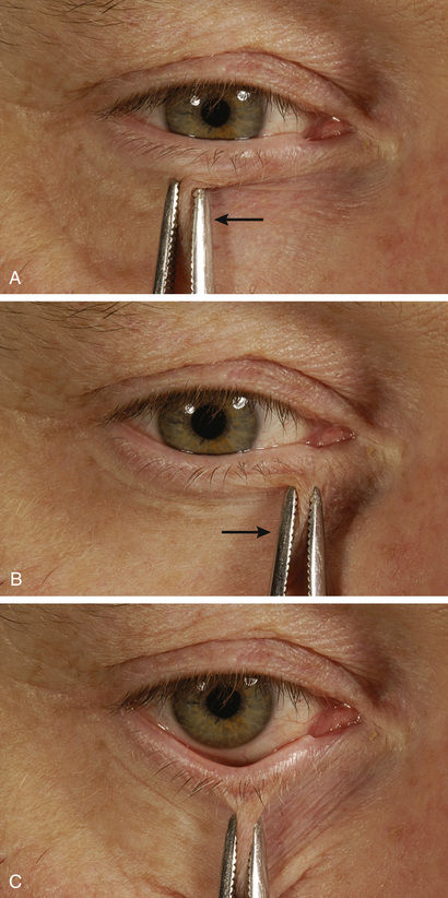Lower Eyelid and Eyelash Malpositions | Ento Key