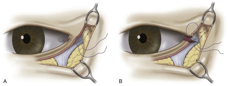 Lower Eyelid and Eyelash Malpositions | Ento Key