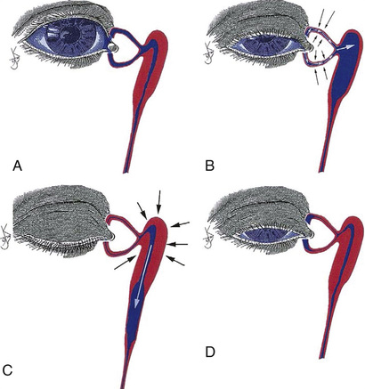 Disorders of the Lacrimal System | Ento Key