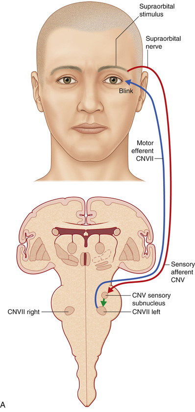 Blepharospasm and Other Facial Spastic Disorders | Ento Key