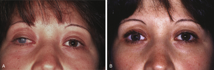The Anophthalmic Socket and Complications | Ento Key