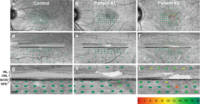 Macular Telangiectasia | Ento Key