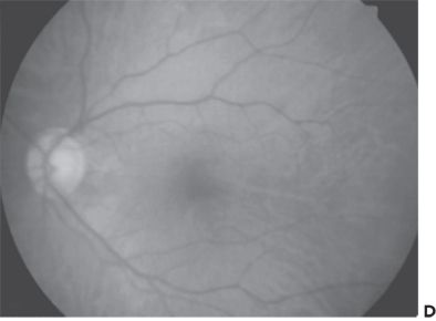 Normal Anatomy of the Macula | Ento Key