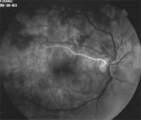 Normal Anatomy of the Macula | Ento Key