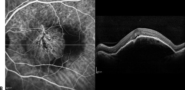 Classification of Exudative Age-Related Macular Degeneration | Ento Key