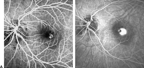 Classification of Exudative Age-Related Macular Degeneration | Ento Key
