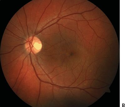 Differential Diagnosis of Age-Related Macular Degeneration | Ento Key