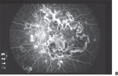 Differential Diagnosis of Age-Related Macular Degeneration | Ento Key