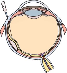 Introduction to Gene Therapy and Related Techniques for Retinal ...
