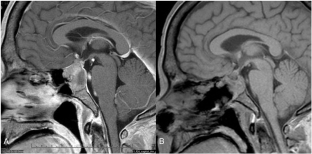 Acromegaly: otolaryngic manifestations following pituitary surgery ...
