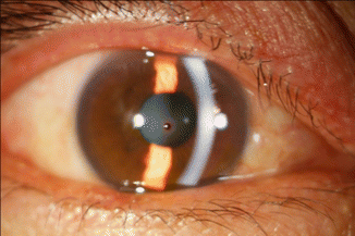 Intraocular Foreign Bodies | Ento Key