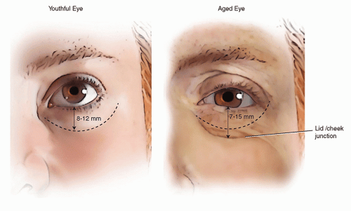 Lower Eyelid Blepharoplasty Techniques | Ento Key
