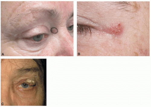 Management of Malignant Eyelid Lesions | Ento Key
