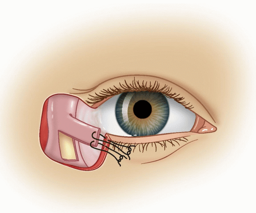 Lower Eyelid Reconstruction | Ento Key